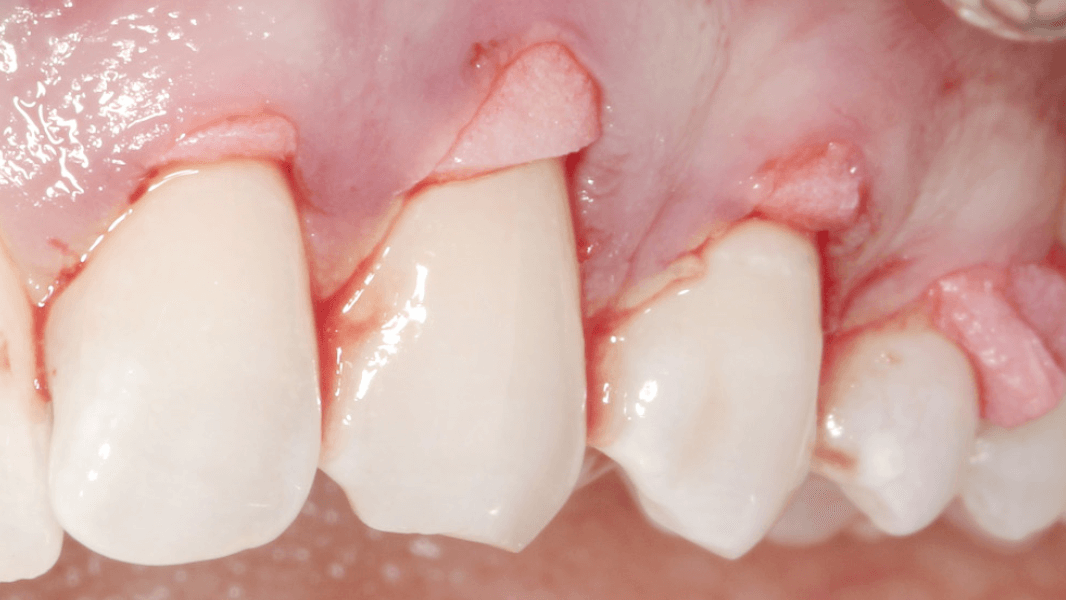 NovoMatrix® matrice tissulaire