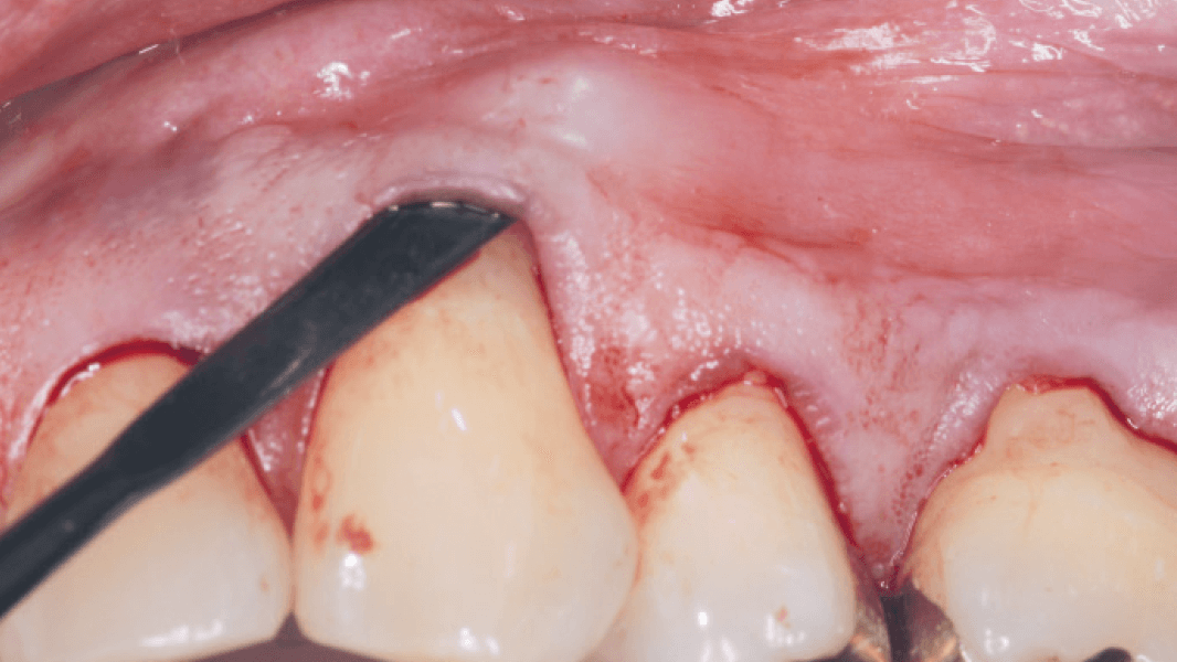 NovoMatrix® matrice tissulaire