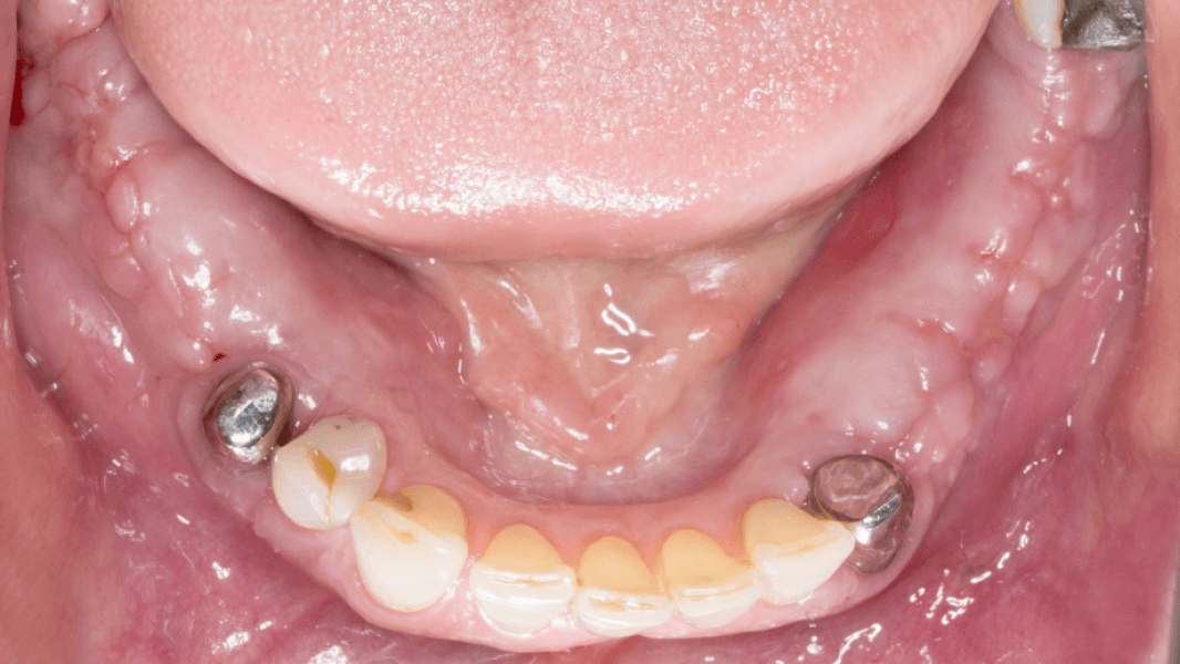 NovoMatrix® matrice tissulaire