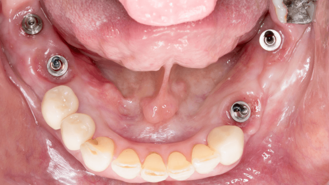 NovoMatrix™ | Camlog